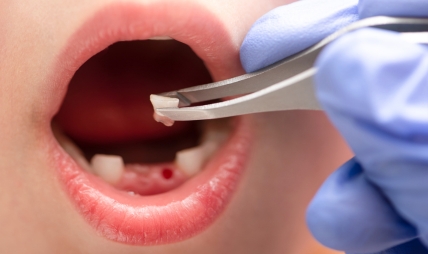Dangers of Ignoring a Rotten Tooth: Why Extraction Matters?
